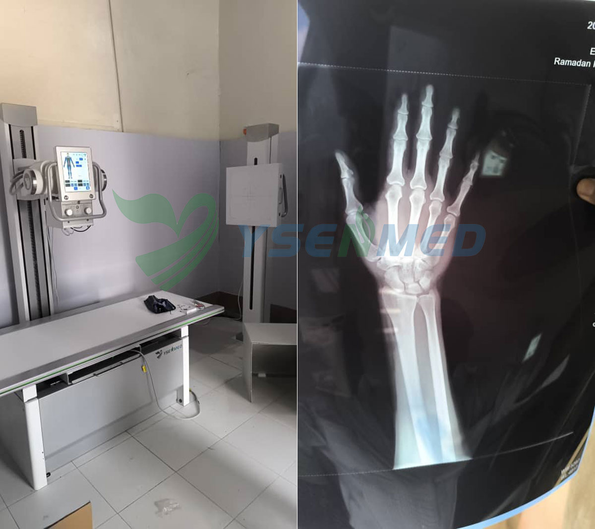 YSX500D digital x-ray system set up in a hospital in Somalia